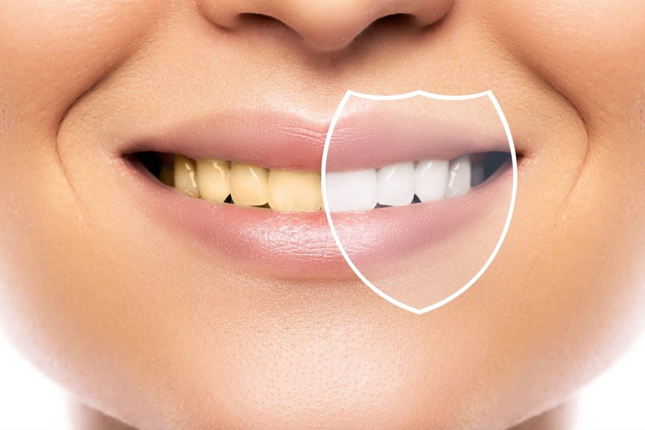 Is Composite Bonding Bad for Your Teeth? Get Details